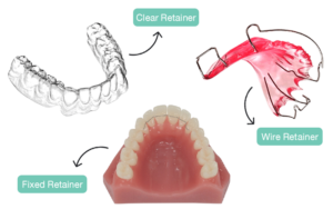 Retainer – AU Dental