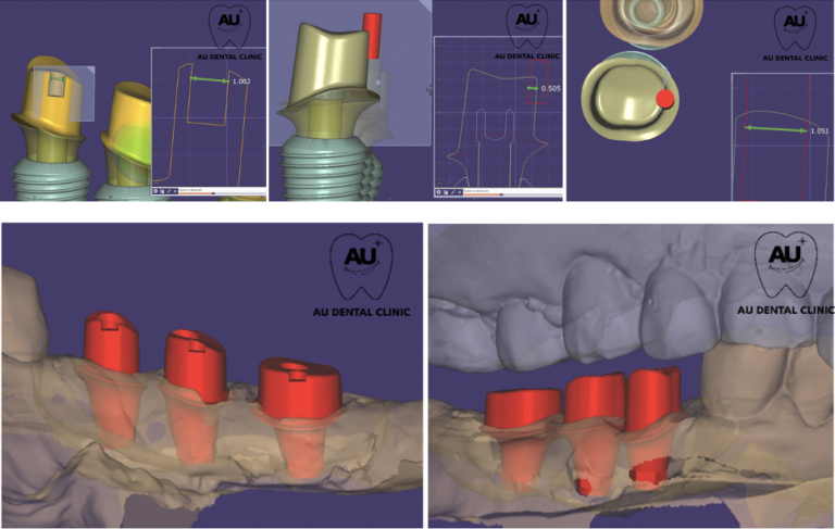 What is a ‘Customized Abutment’? – AU Dental