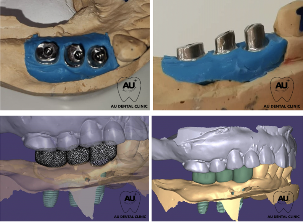 What is a ‘Customized Abutment’? – AU Dental